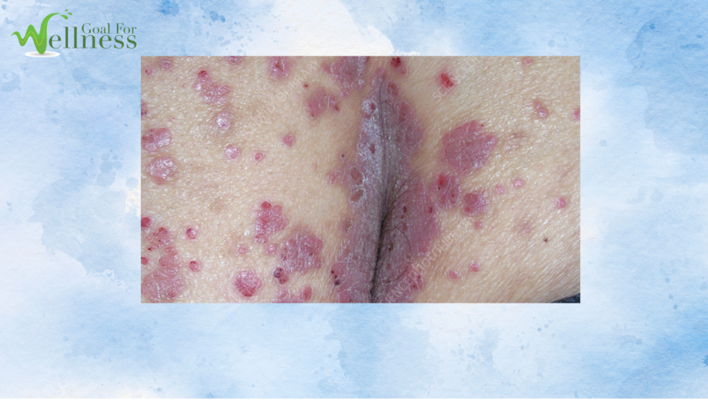 Psoriasis on Buttocks: A Comprehensive Guide - Goal for Wellness